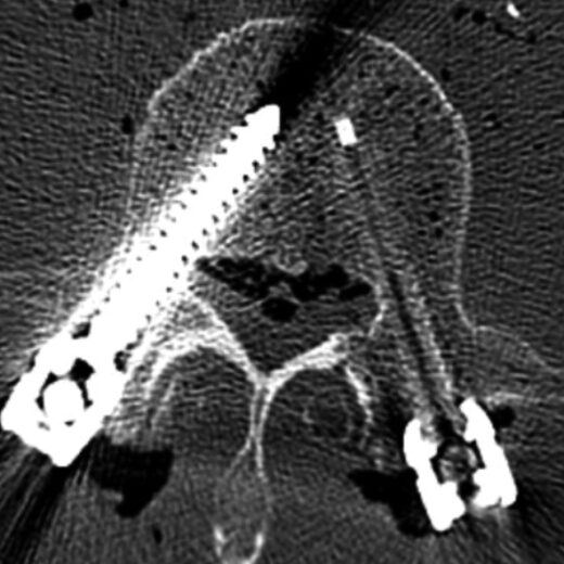 Spinal Surgery News: BlackArmor® Carbon/PEEK Implants | icotec