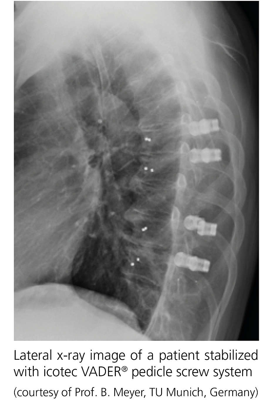 FDA Clearance: VADER®one Pedicle Screw System | icotec