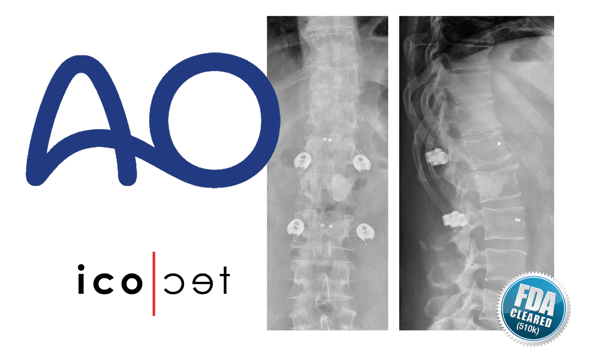 AO and icotec Join Forces on New Spinal Stabilization System | icotec