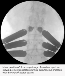 FDA Clearance: VADER® Pedicle System with Bone Cement Augmentation | icotec