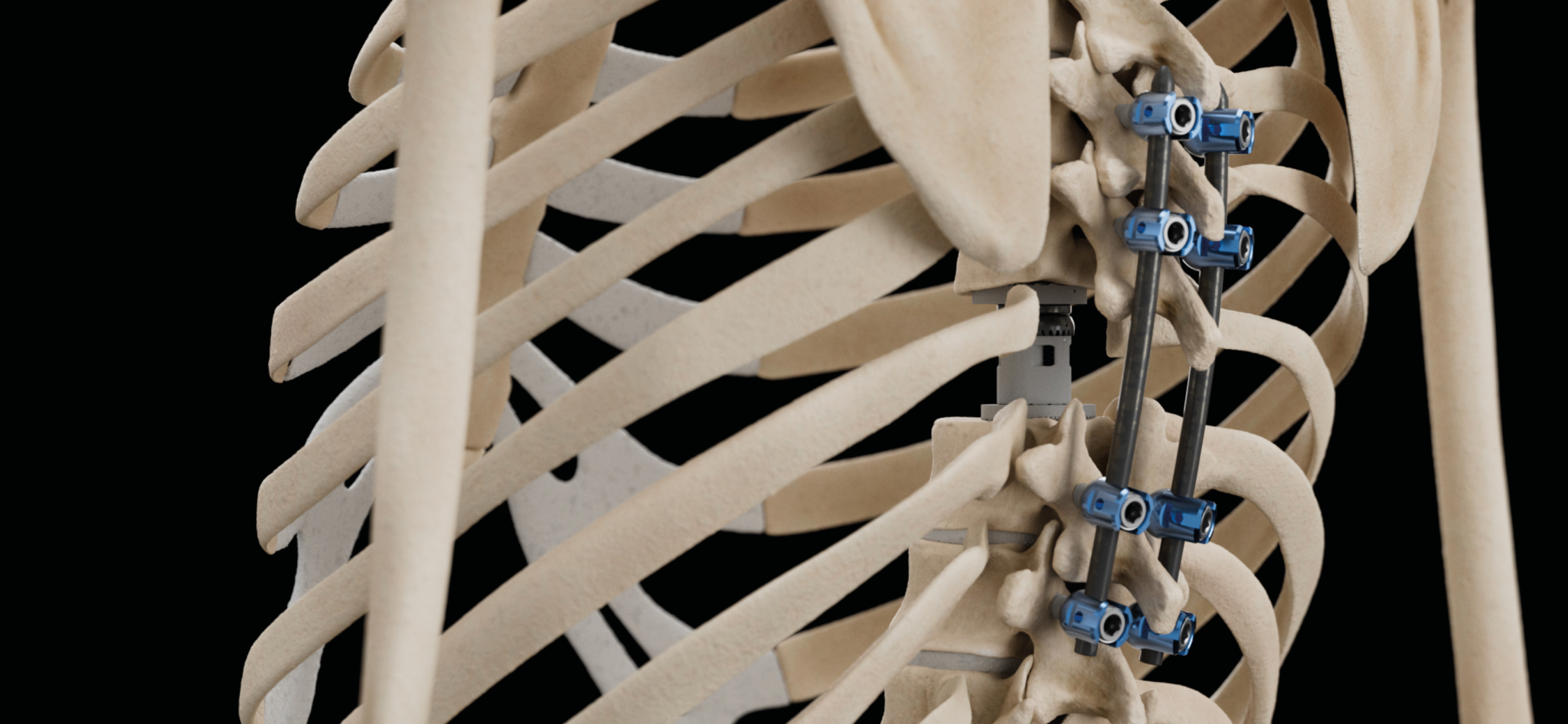 Expandable VBR I KONG®-TL VBR System