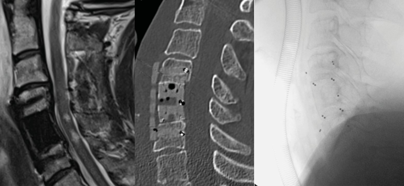 Cervical Plate System I icotec Anterior Cervical Plate
