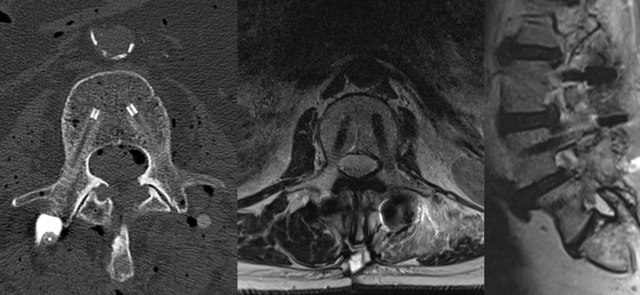 Stabilization of the Spine I VADER® Pedicle System