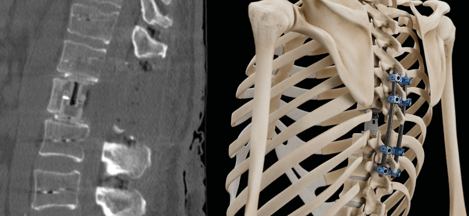 Stabilization of the Spine I VADER® Pedicle System