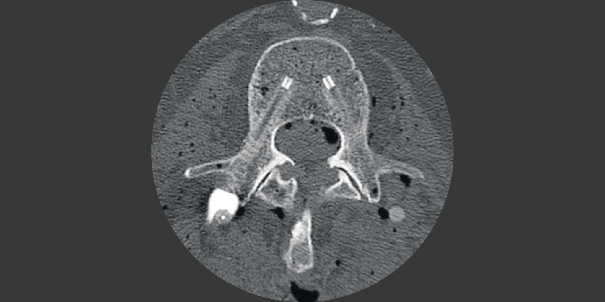 BlackArmor® Carbon/PEEK I icotec