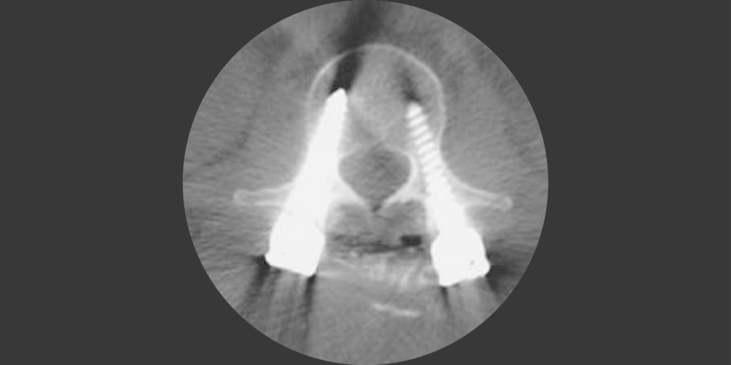 BlackArmor® Carbon/PEEK I icotec