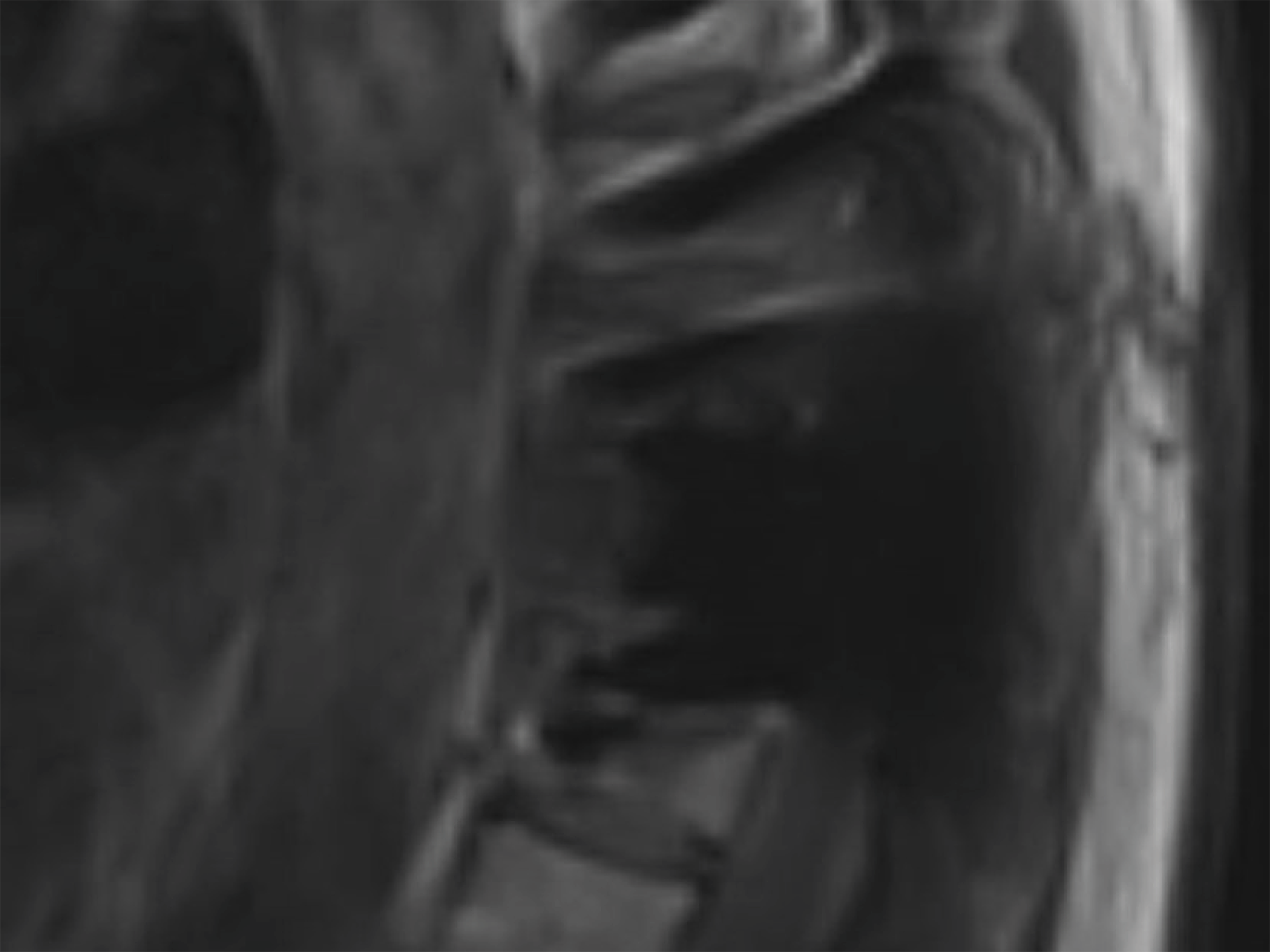 BlackArmor® Carbon/PEEK I icotec