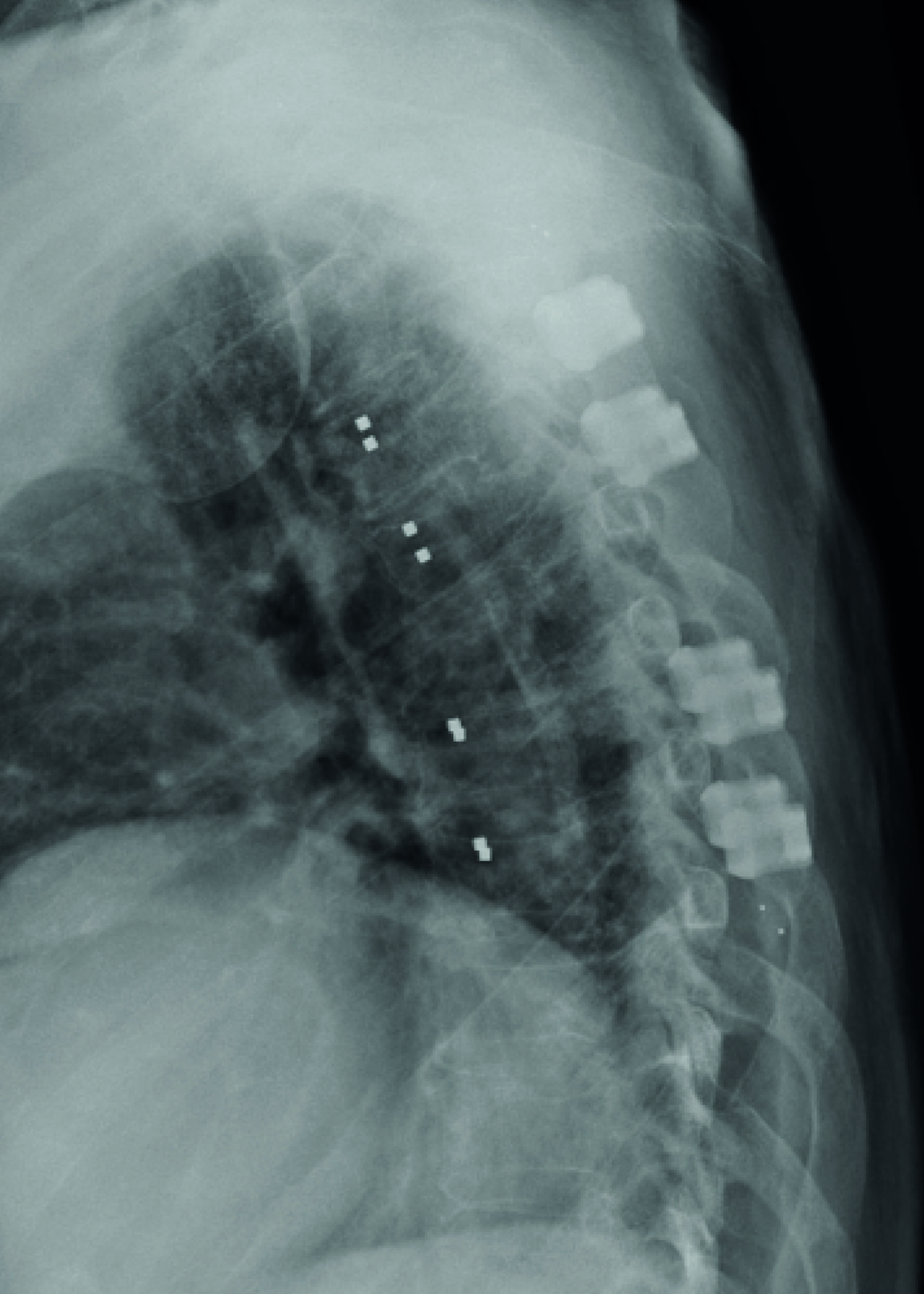 FDA Clearance for the Ø 4.5 mm VADER® Pedicle Screws | icotec