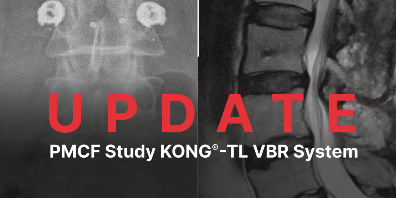 Completion of 50% for the PMCF study with the KONG®-TL VBR system | icotec