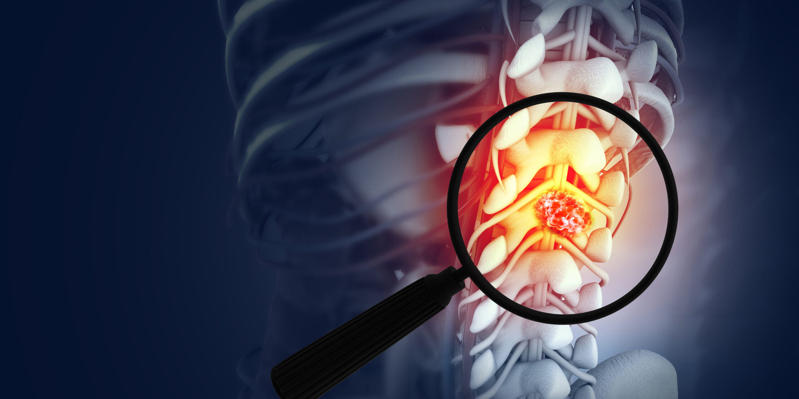 Exploring the Diagnostic Process for Spine Tumors | icotec