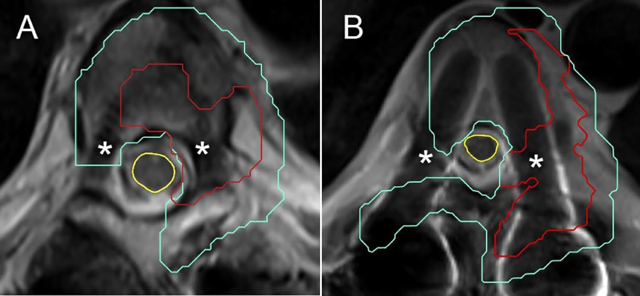 BlackArmor® Carbon/PEEK Optimizes Radiation Therapy for Improved ...